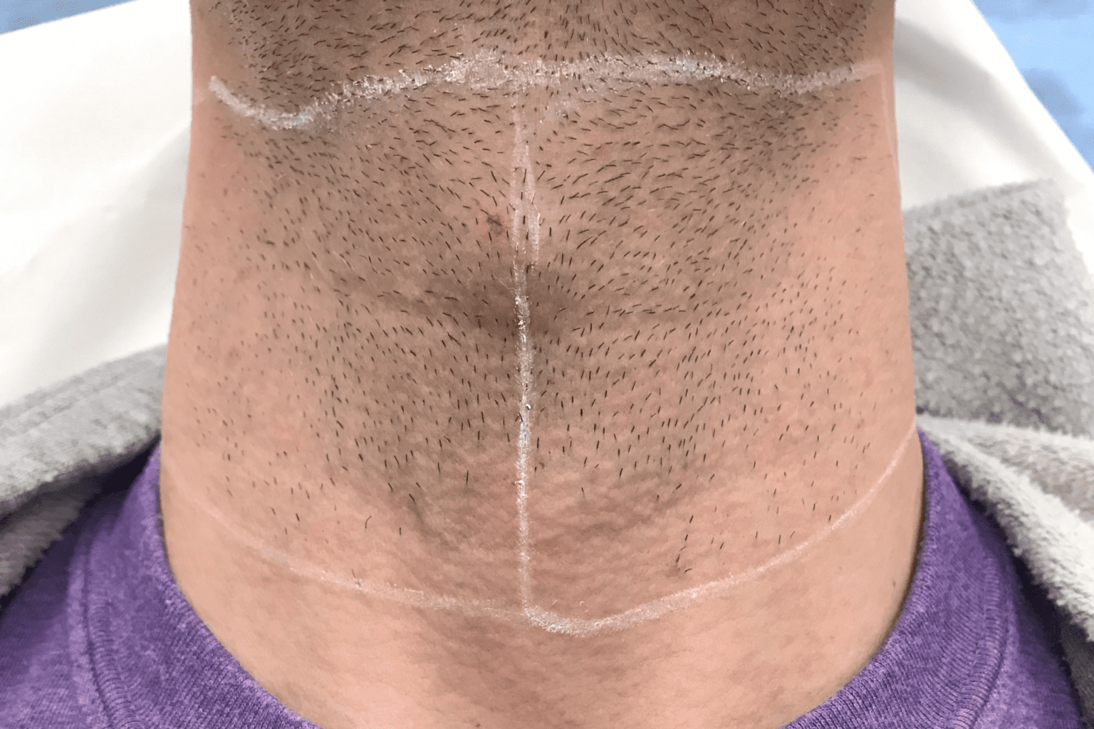 Laser Hair Removal Calgary | LPSA