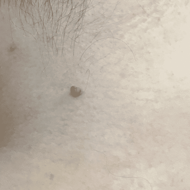 Mole and Skin Tag Removal Before and Afters