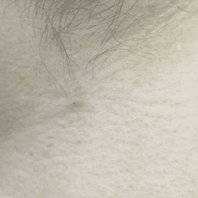 Mole and Skin Tag Removal Before and Afters